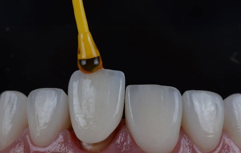 Understanding the Process: How to Put a Cap On - Dental Crowns ...